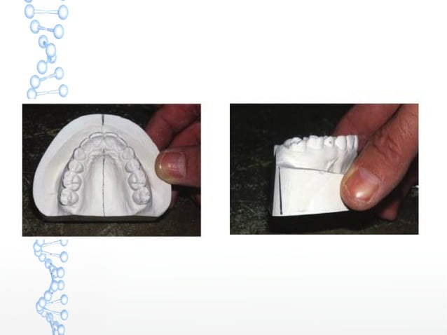BASING AND TRIMMING OF ORTHODONTIC MODELS | ODP