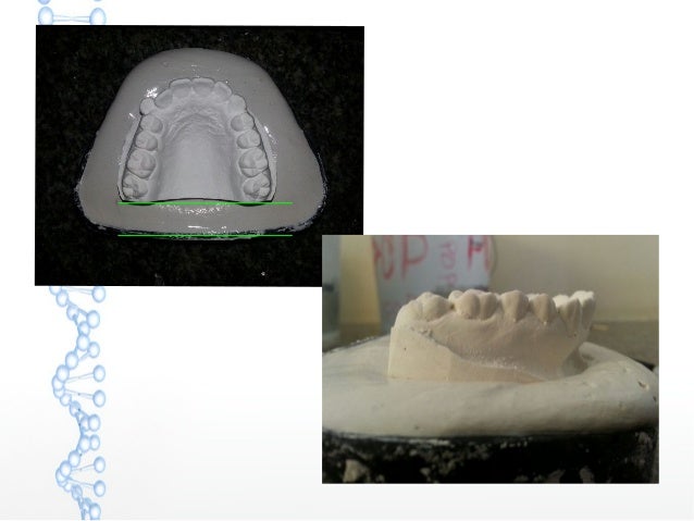 BASING AND TRIMMING OF ORTHODONTIC MODELS
