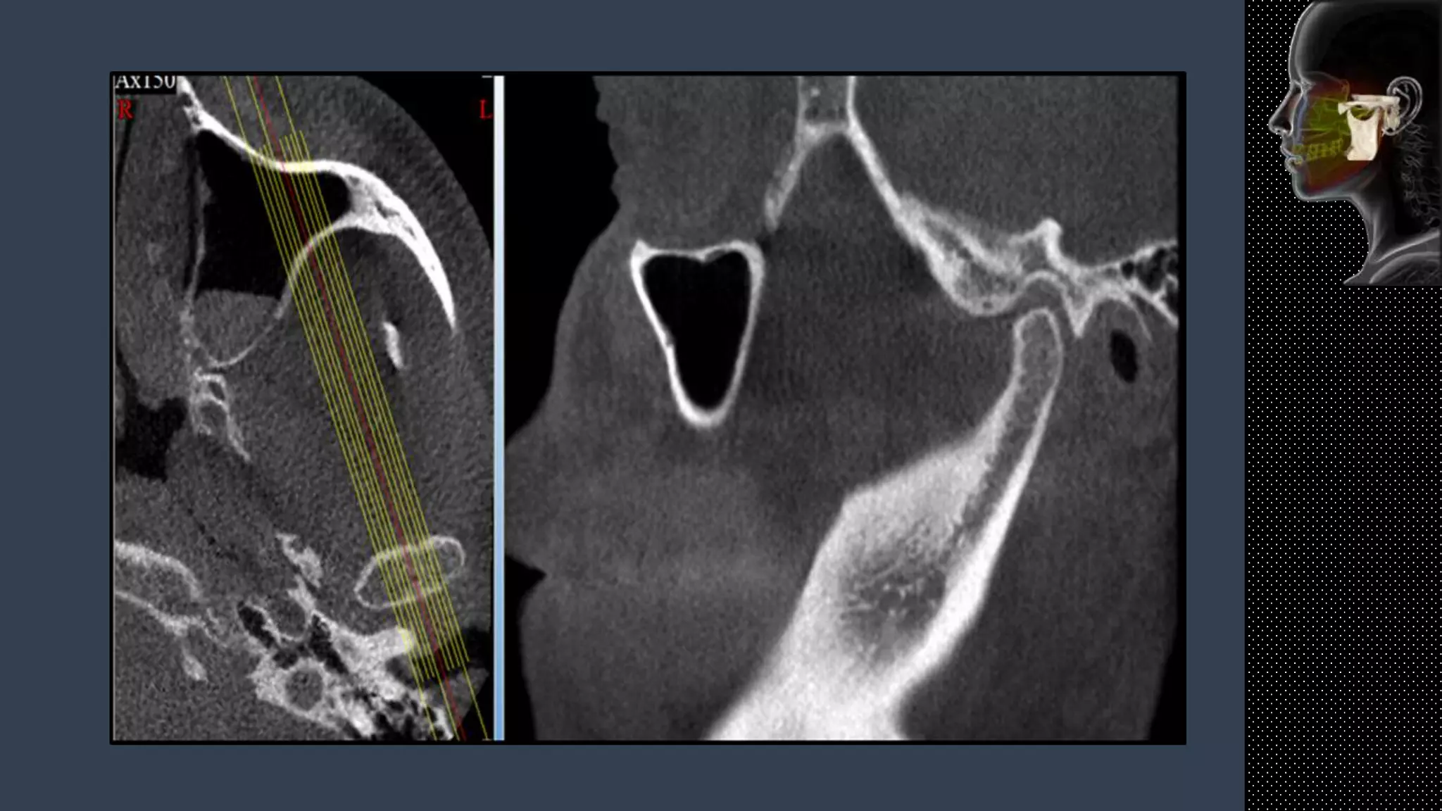 IS THERE ANY CORRELATION BETWEEN BONE QUALITY AND MANDIBULAR ...