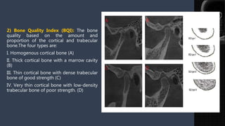 IS THERE ANY CORRELATION BETWEEN BONE QUALITY AND MANDIBULAR ...