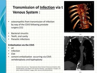 Plexo Venoso de Batson | PPT