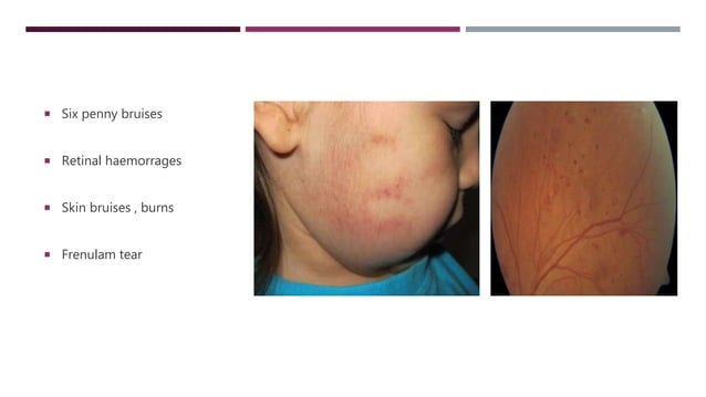 battered baby synd^.^.^^-1.pptx