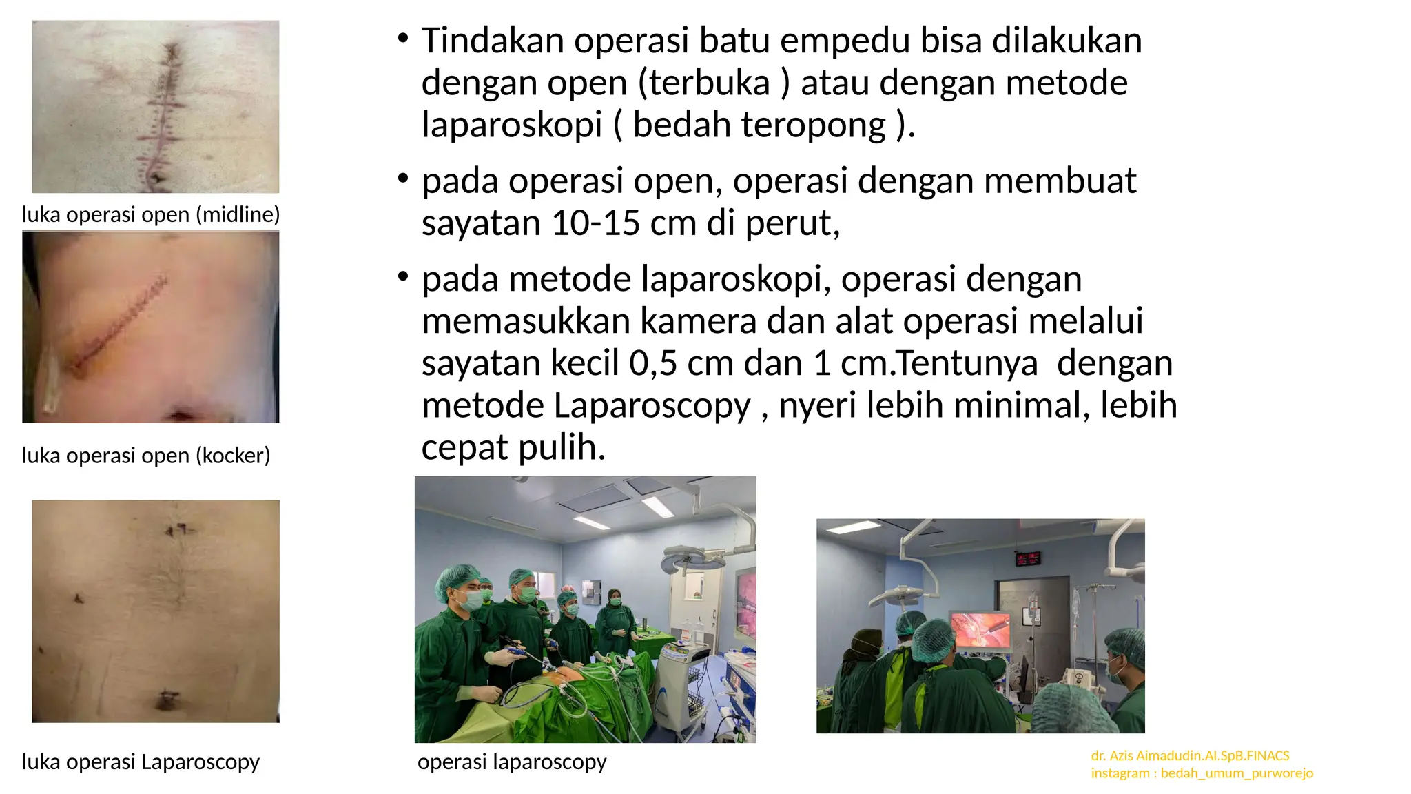 BATU EMPEDU cholelithiasis laparoscopy batu empedu | PPTX