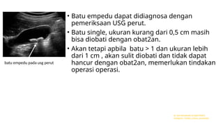 BATU EMPEDU cholelithiasis laparoscopy batu empedu | PPTX