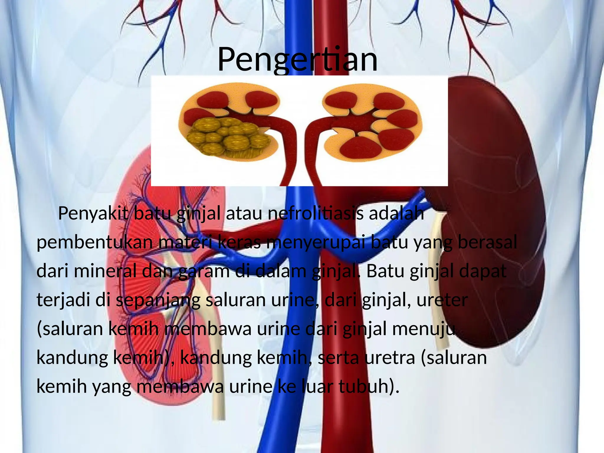 Penyakit Batu Ginjal - anatomi fisiologi | PPTX