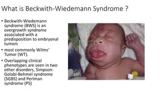 Beckwith Wiedemann Syndrome