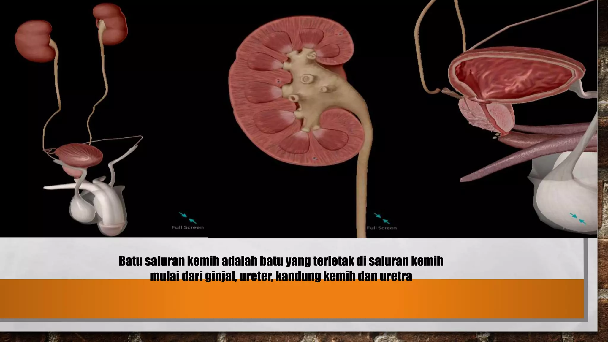 Batu saluran kemih | PPTX