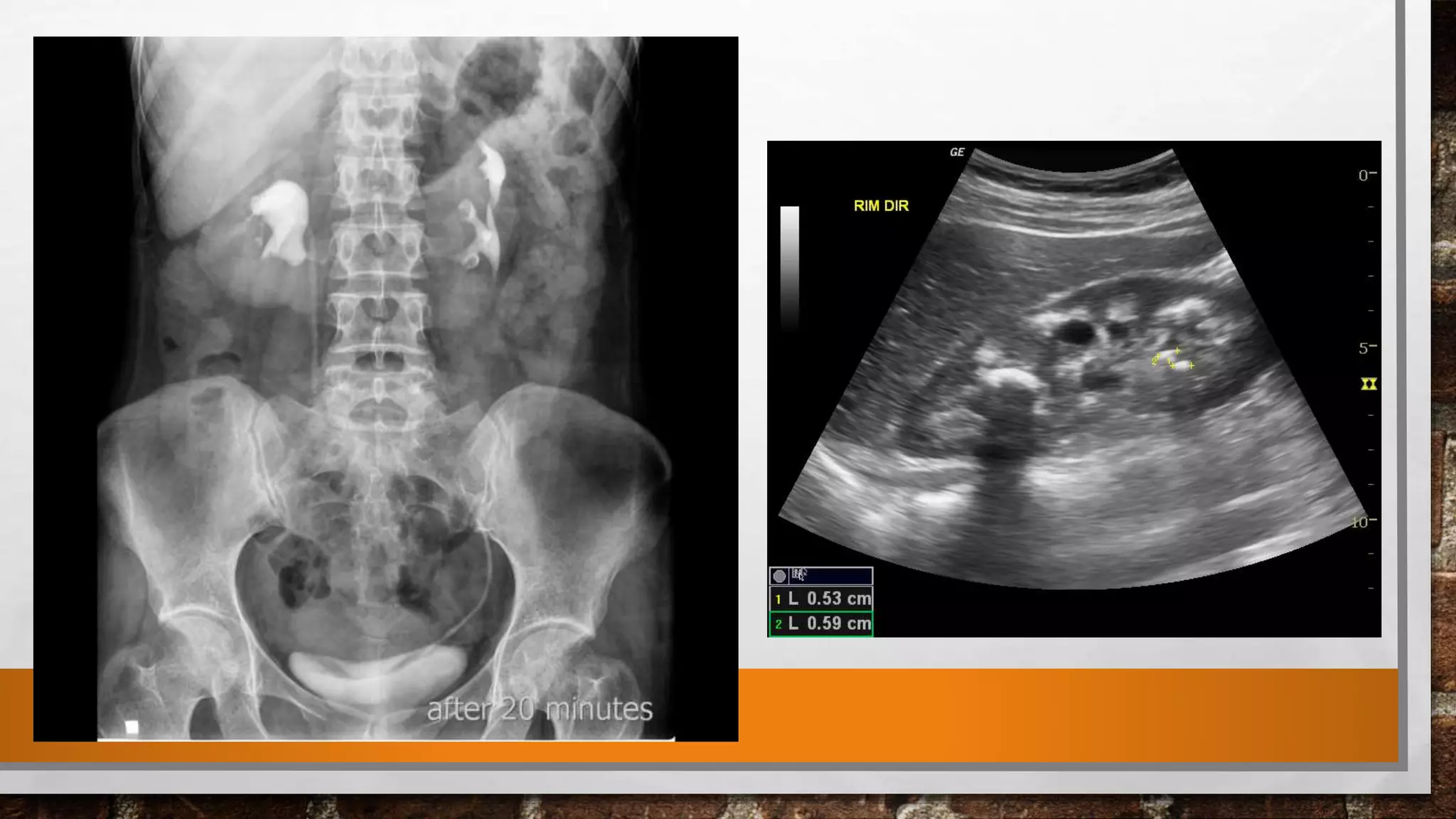 Batu saluran kemih | PPTX