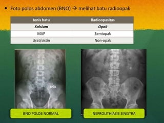 Batu Urinarius - Patofisiologi dan Pencegahan_Mario.pptx