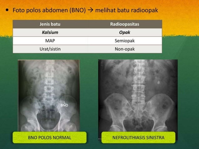 Batu Urinarius - Patofisiologi dan Pencegahan_Mario.pptx