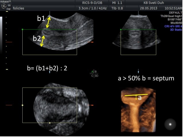 Septum Uterusa Je Li Resekcija Opravdana Septate Uterus Is Resec