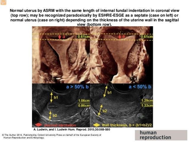 Septum Uterusa Je Li Resekcija Opravdana Septate Uterus Is Resec