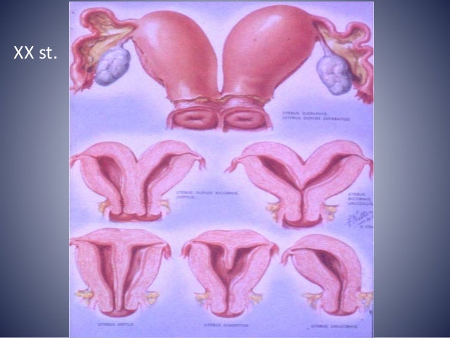 Septum Uterusa Je Li Resekcija Opravdana Septate Uterus Is Resec