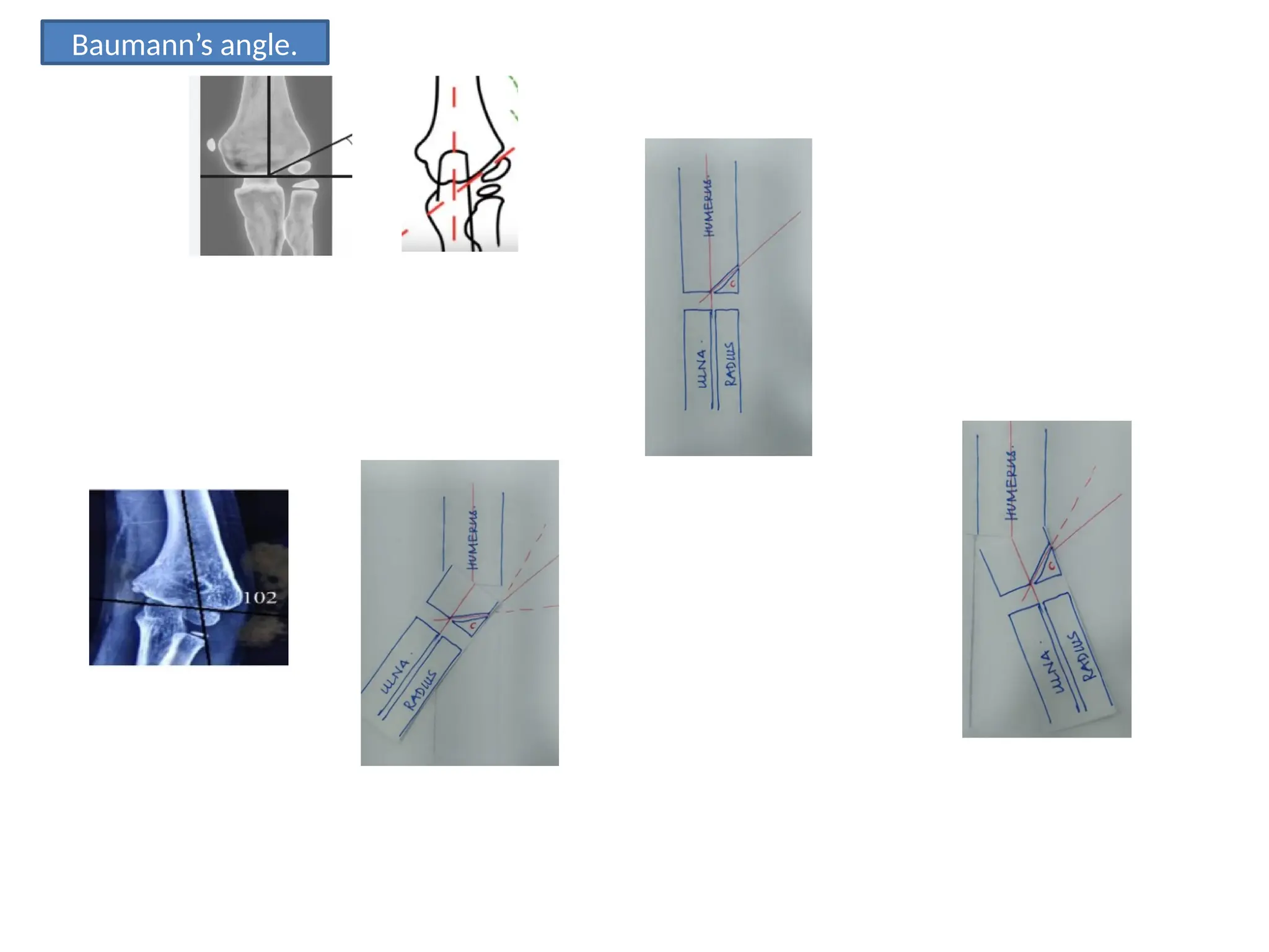 Baumann's angle, cubitus varus,Cubitus valgus.pptx