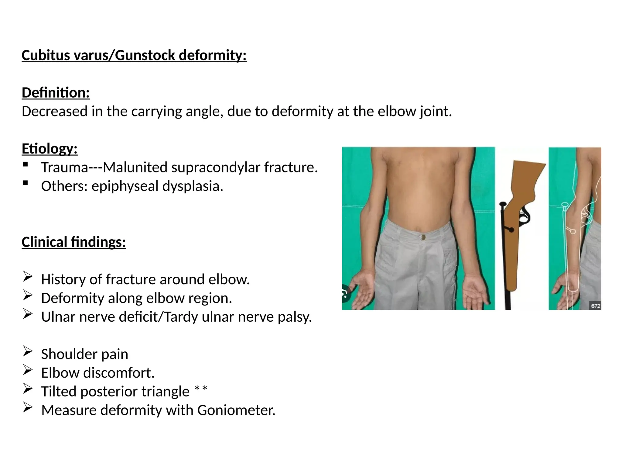 Baumann's angle, cubitus varus,Cubitus valgus.pptx