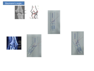 Baumann's angle, cubitus varus,Cubitus valgus.pptx
