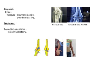 Baumann's angle, cubitus varus,Cubitus valgus.pptx