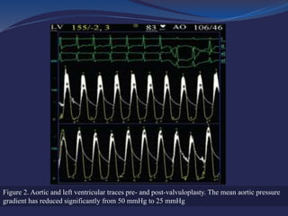 BALLOON AORTIC VALVULOPLASTY | PPTX