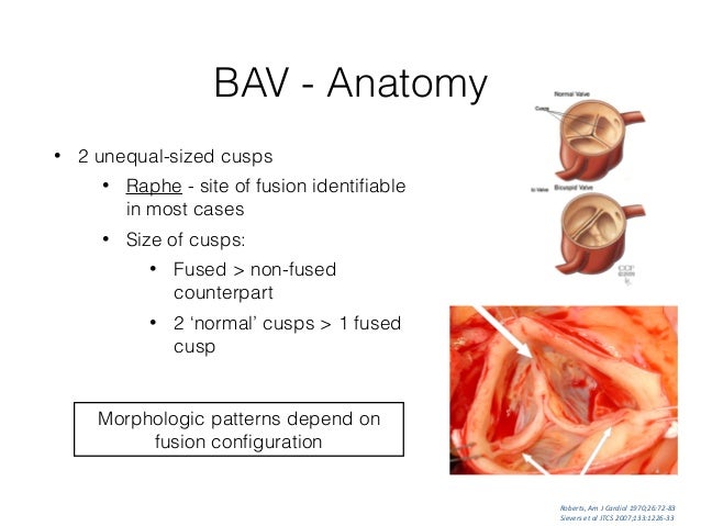 Bicuspid Aortic Valve and Aortopathy