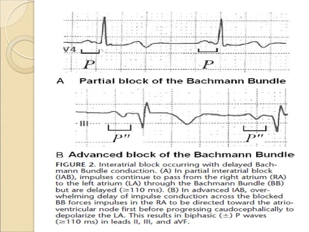 Bayes syndrome and atrial fibrillation and stroke | PPT