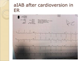 Bayes syndrome and atrial fibrillation and stroke | PDF