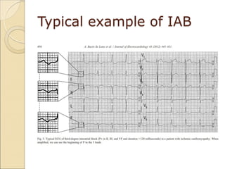 Bayes syndrome and atrial fibrillation and stroke | PDF