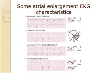 Bayes syndrome and atrial fibrillation and stroke | PDF