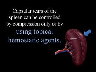Spleen Trauma | PPTX