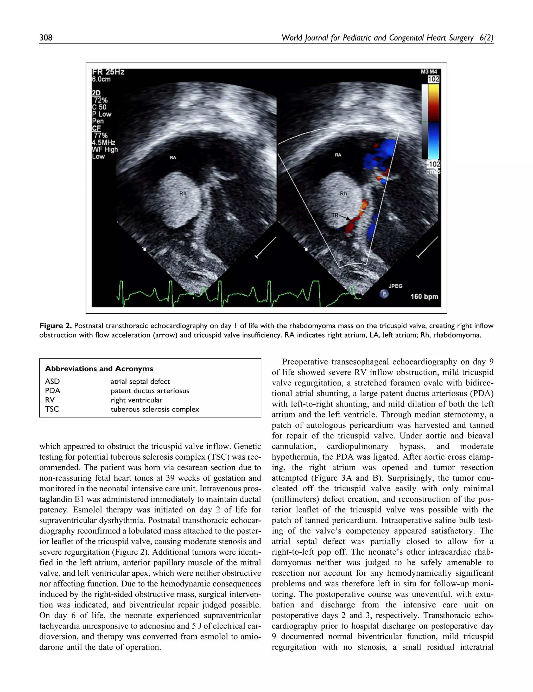 Rhabdomyoma in neonate WJPCHS | PDF