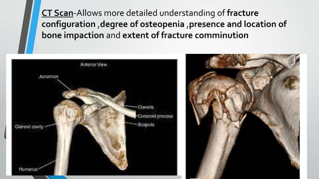 Comparative study of ORIF with philos plate vs CRIF with k wiring of ...