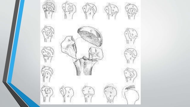 Comparative study of ORIF with philos plate vs CRIF with k wiring of ...