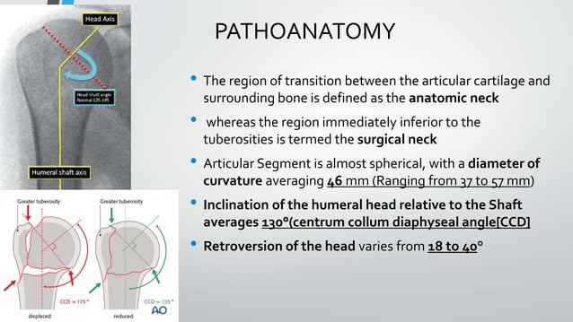 Comparative study of ORIF with philos plate vs CRIF with k wiring of ...