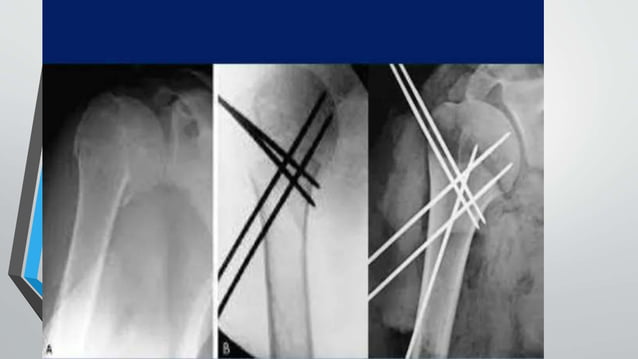Comparative study of ORIF with philos plate vs CRIF with k wiring of ...