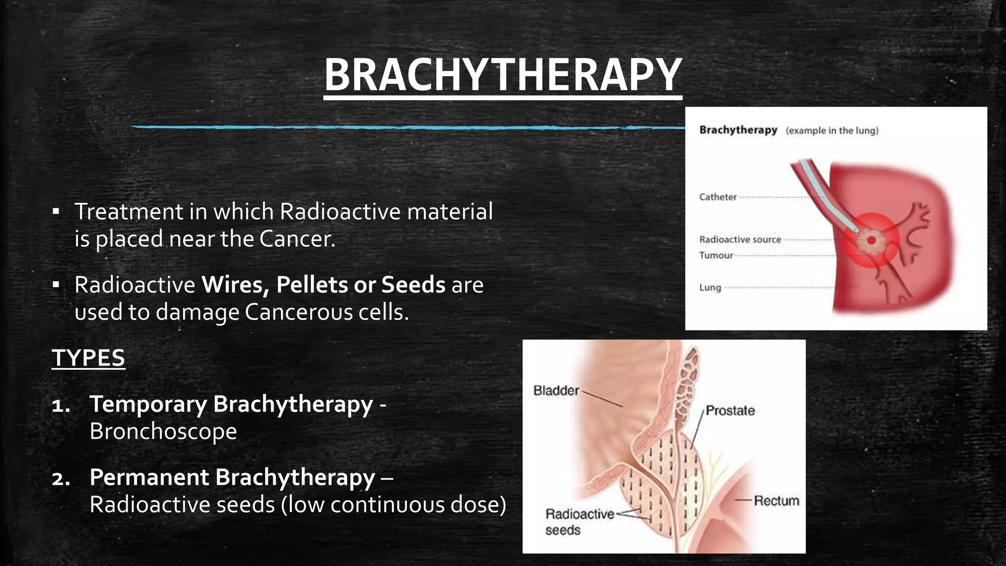 Radiation Therapy and Physical Therapy | PPTX