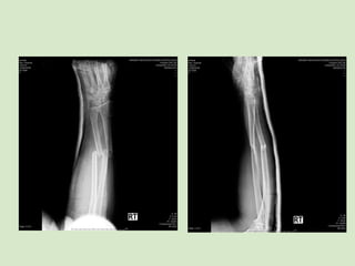 Bb fx forearm | PPTX