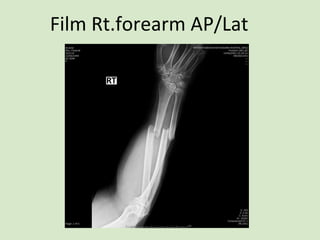 Bb fx forearm | PPT