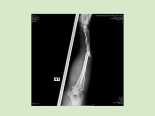 Bb fx forearm | PPTX