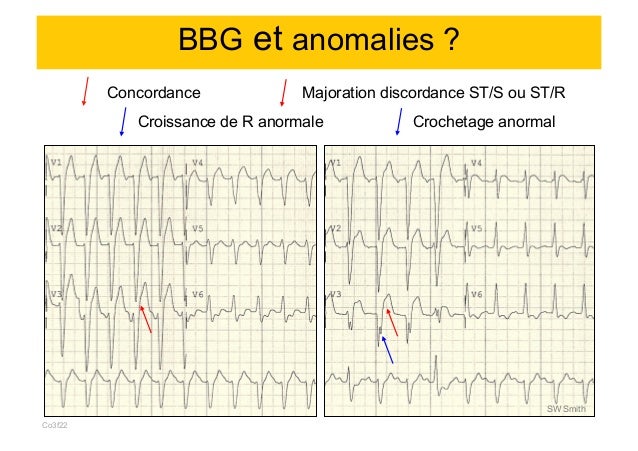 ECG : BBG et cardiopathie ischemique JNUC3 5 dec 14