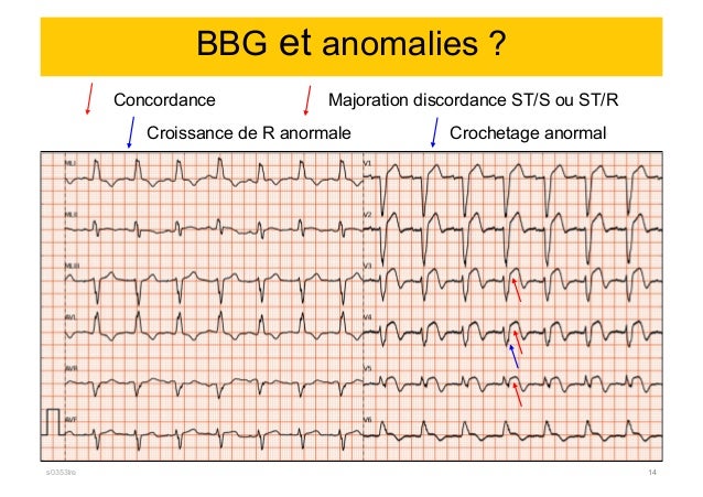 ECG : BBG et cardiopathie ischemique JNUC3 5 dec 14