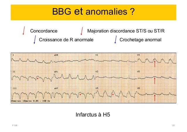 ECG : BBG et cardiopathie ischemique JNUC3 5 dec 14