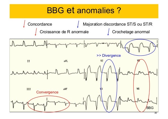 ECG : BBG et cardiopathie ischemique JNUC3 5 dec 14