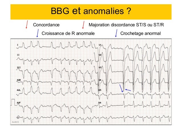 ECG : BBG et cardiopathie ischemique JNUC3 5 dec 14