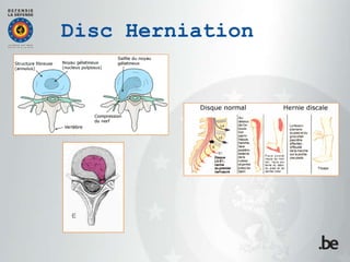Surgical Treatment of Low Back Pain & Sciatics | PPT
