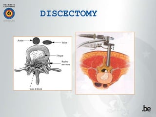 Surgical Treatment of Low Back Pain & Sciatics | PPT