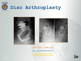 Surgical Treatment of Low Back Pain & Sciatics | PDF