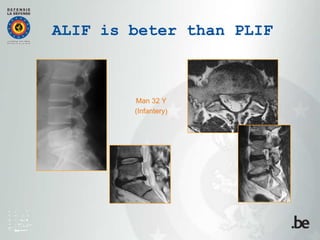 Surgical Treatment of Low Back Pain & Sciatics | PDF