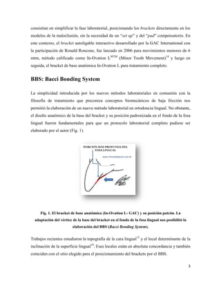 Sistema Laboratorial en Ortodoncia Lingual: Bacci Bonding System - BBS ...