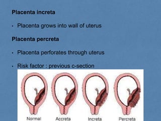 ob:gyn Postpartum hemorrhage sanlucas | PPTX