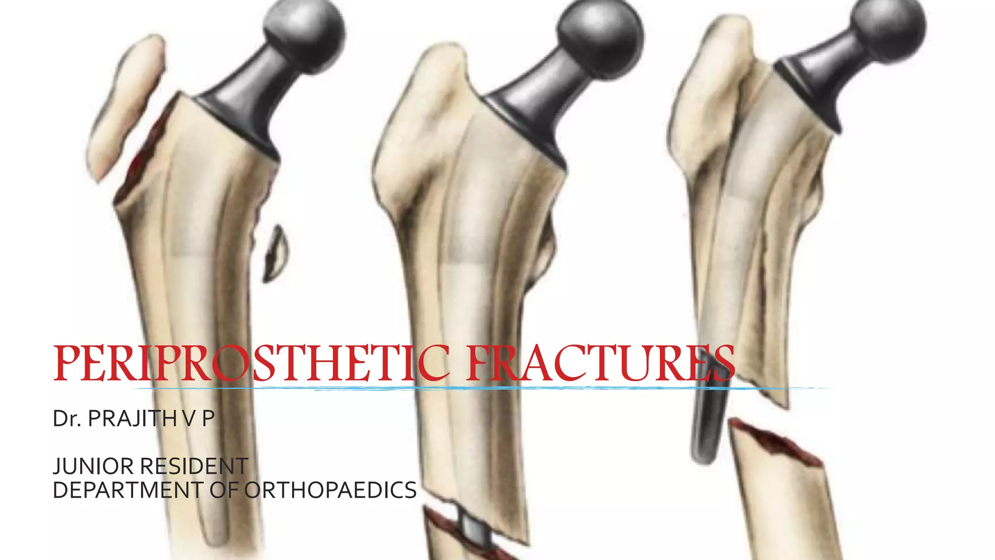 Periprosthetic fractures | PPTX
