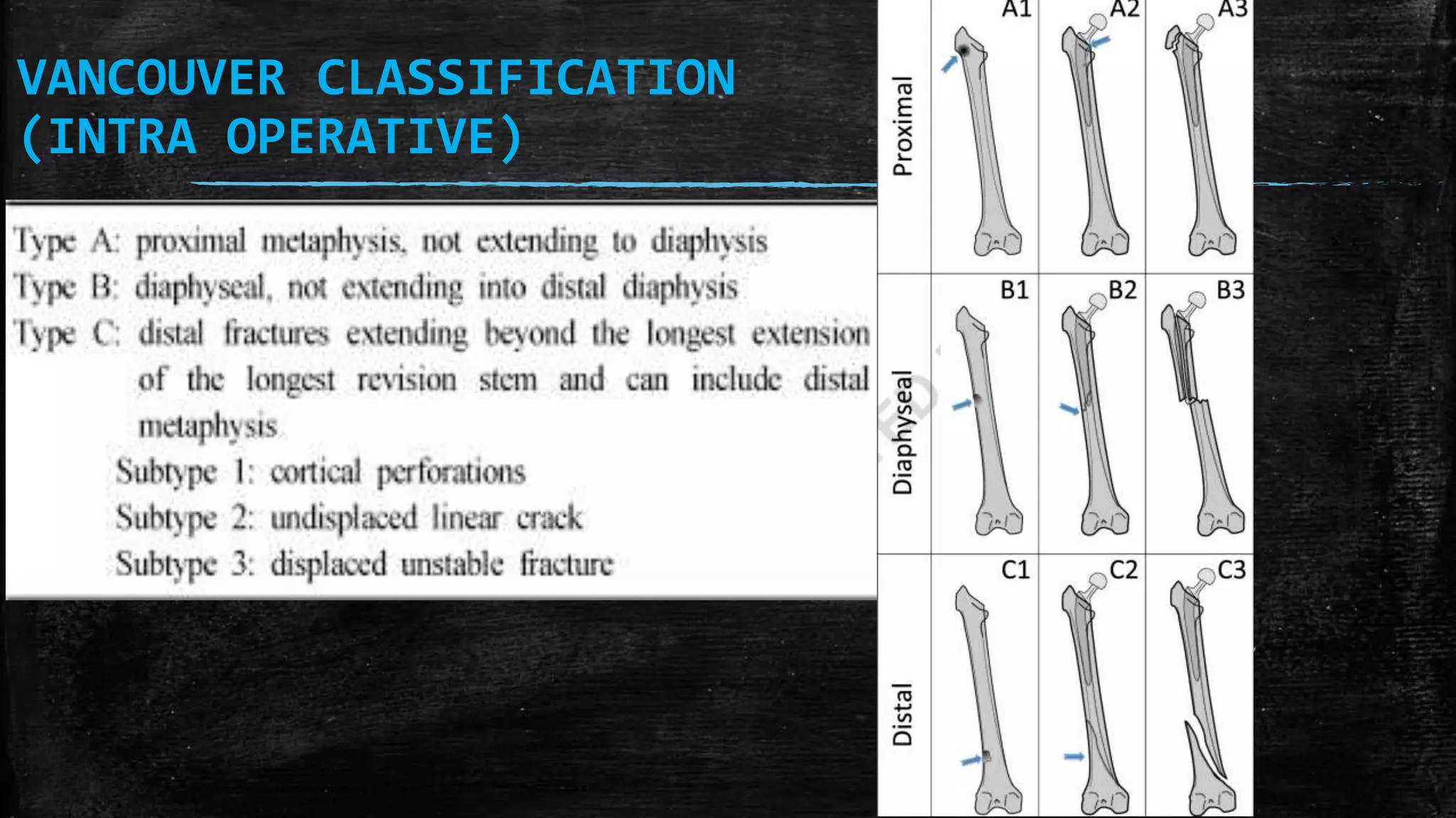 Periprosthetic fractures | PPTX